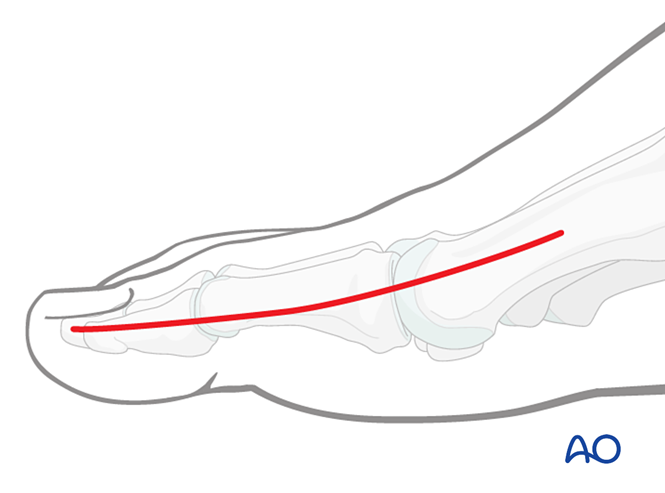 Orif K Wires For Complete Articular Fractures Of The Proximal Hallux