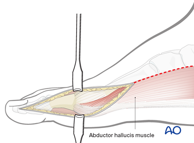 Medial approach to the hallux