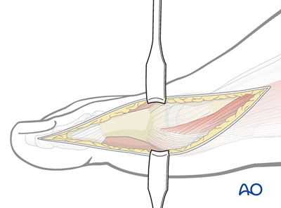 Medial approach to the hallux