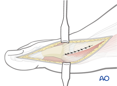 Medial approach to the hallux