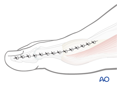 Medial approach to the hallux