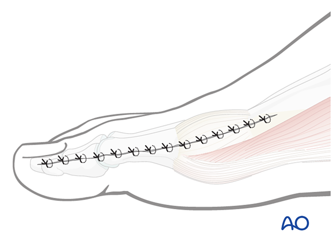 Medial approach to the hallux