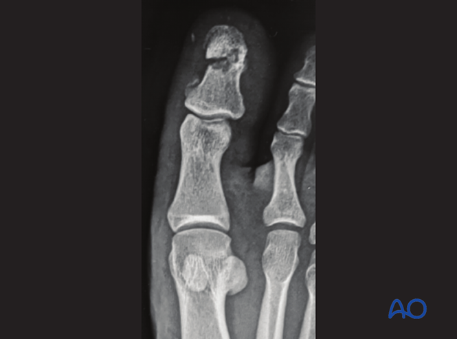 Distal hallux fractures