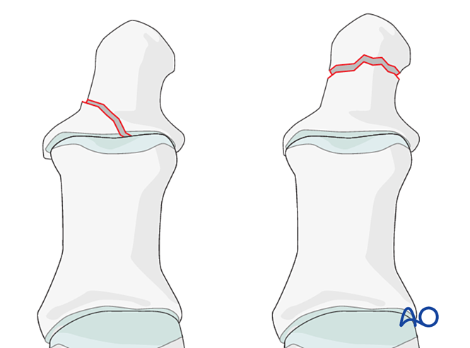 Distal hallux fractures
