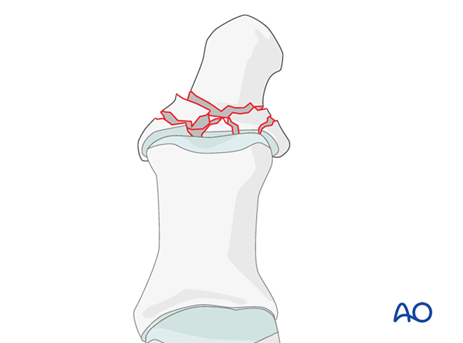 Distal hallux fractures