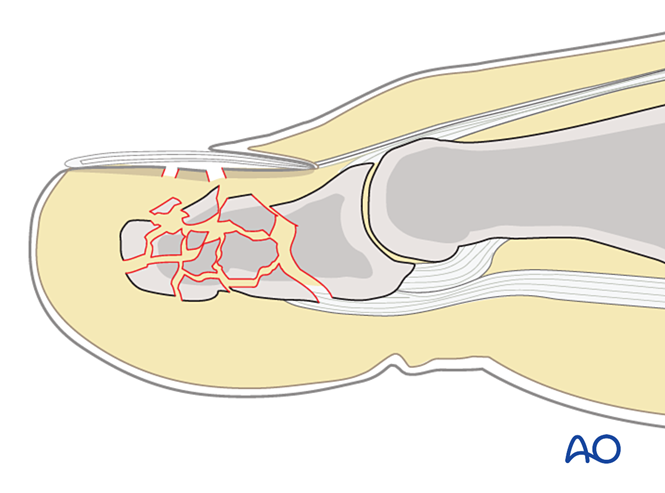 Lesser toe fractures