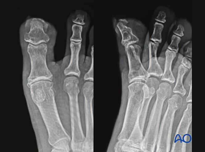 Distal hallux fractures