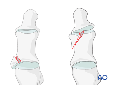 Partial articular fractures of the proximal hallux