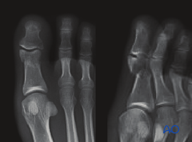 Partial articular fractures of the proximal hallux