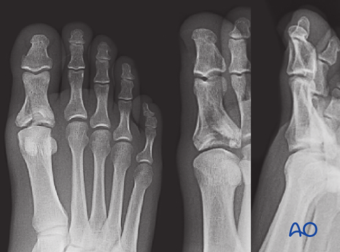 Partial articular fractures of the proximal hallux