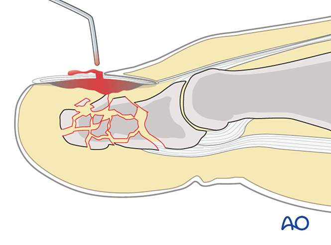 Distal hallux fractures