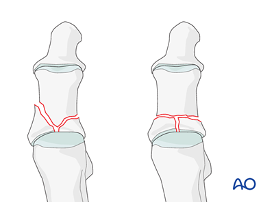 Complete articular fractures of the proximal hallux