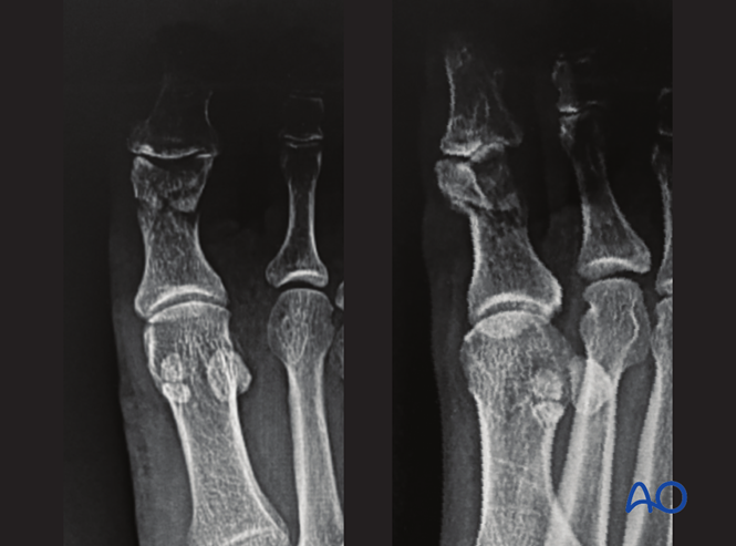 Complete articular fractures of the proximal hallux