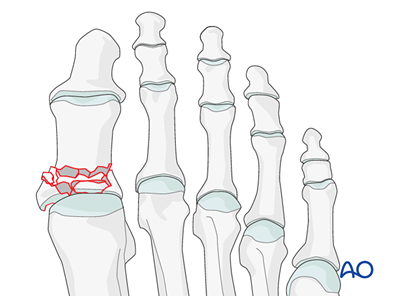 Complete articular fractures of the proximal hallux
