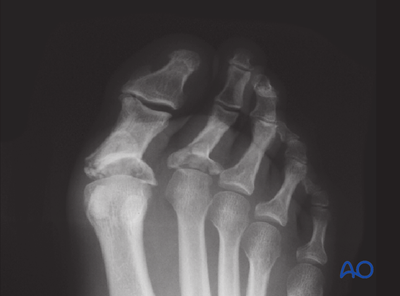 Lesser toe fractures