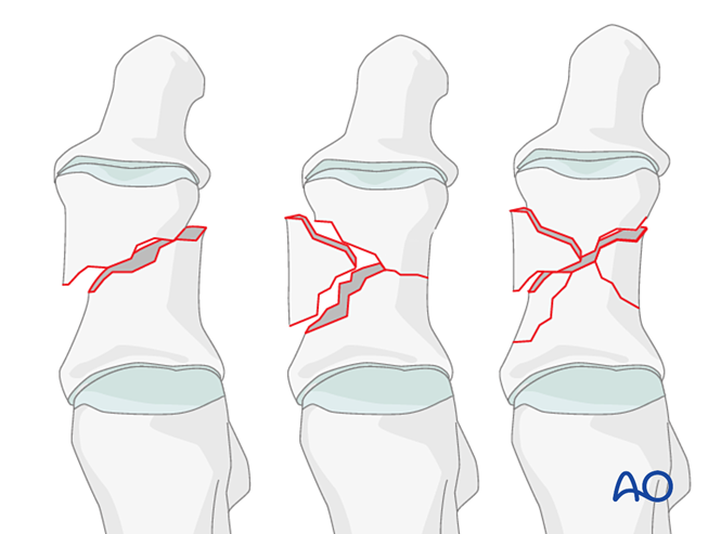 K-wire fixation for Diaphyseal and extraarticular end segment fractures ...