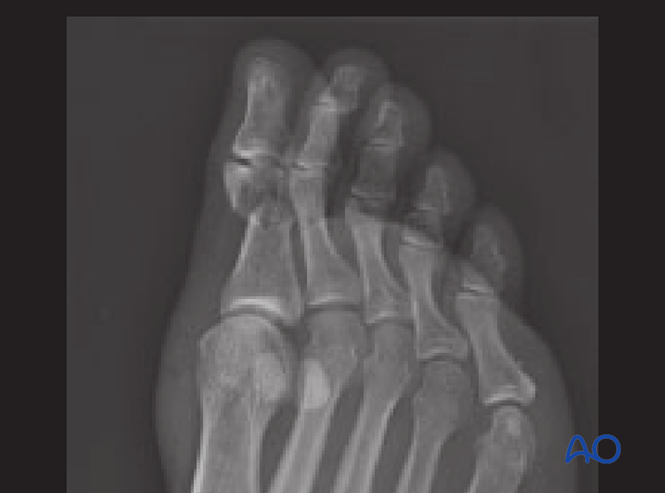 Diaphyseal and extraarticular end segment fractures of the proximal hallux