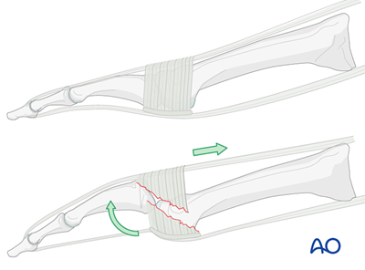 MTP joint dislocation