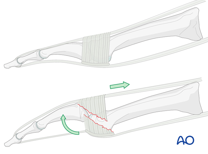 MTP joint dislocation