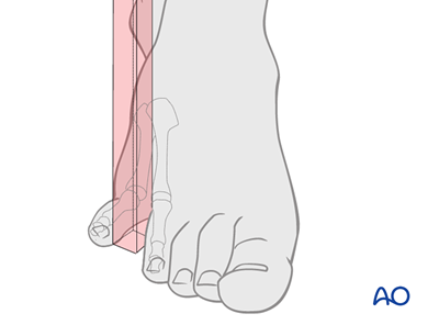 Lesser toe fractures