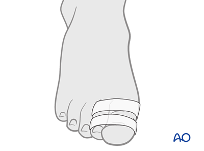 Nonoperative treatment for Lesser toe fractures