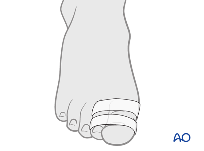 Nonoperative treatment for Lesser toe fractures