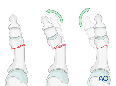 Nonoperative treatment for Lesser toe fractures
