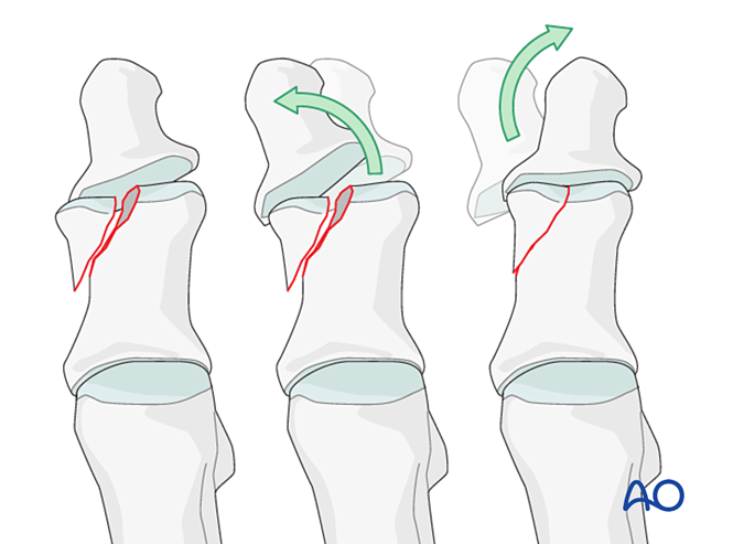Nonoperative treatment for Partial articular fractures of the proximal ...