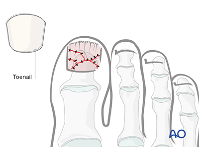 Nail bed reconstruction for Distal hallux fractures