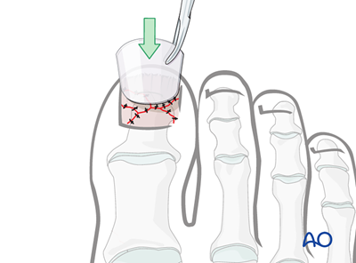 Nail bed reconstruction for Distal hallux fractures