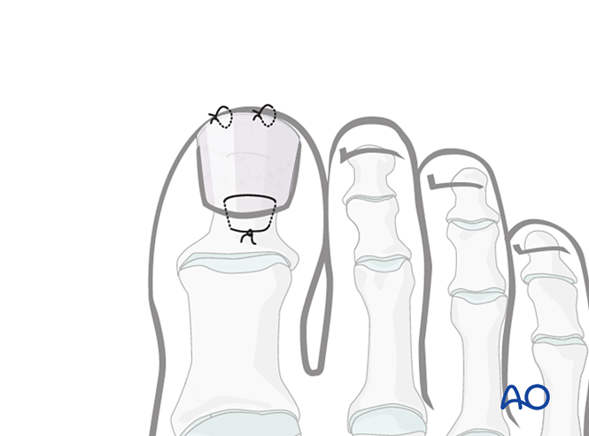 Nail bed reconstruction for Distal hallux fractures