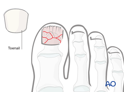 Nail bed excision for Lesser toe fractures