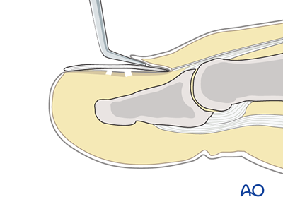 Nail bed excision for Lesser toe fractures