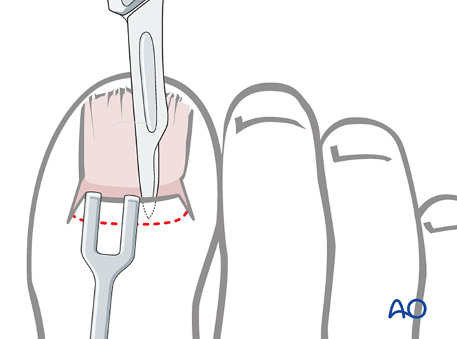 Nail bed excision for Distal hallux fractures