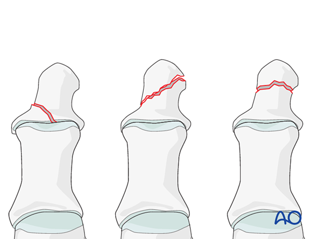 K Wire Fixation For Distal Hallux Fractures
