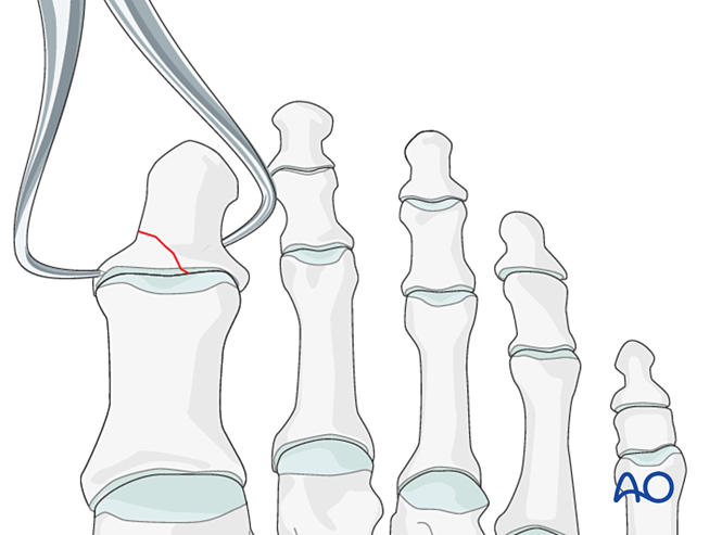 K-wire fixation for Distal hallux fractures