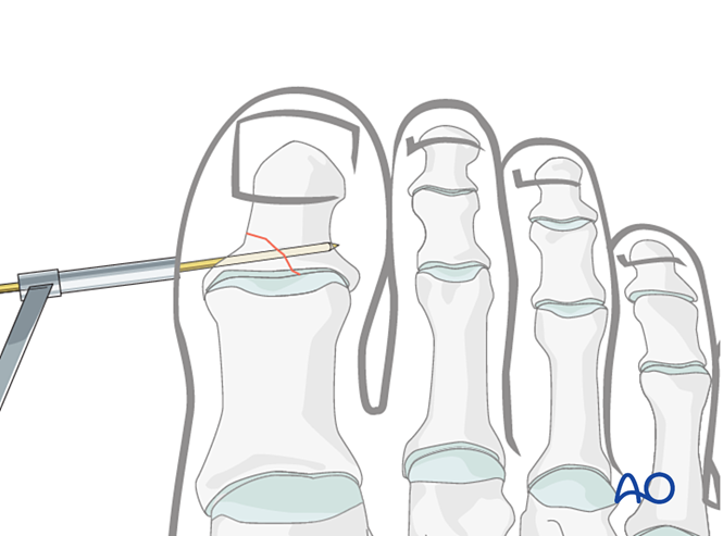 K-wire fixation for Distal hallux fractures
