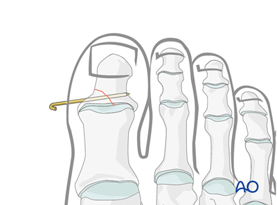 K-wire fixation for Distal hallux fractures