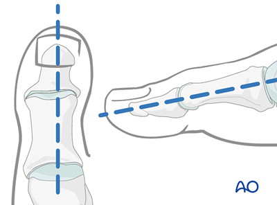 CRIF - K-wire fixation for MTP joint dislocation