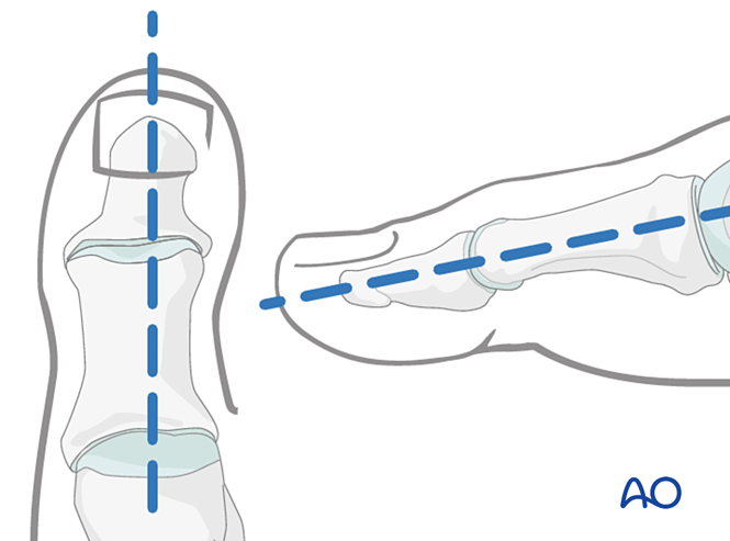 CRIF - K-wire fixation for MTP joint dislocation