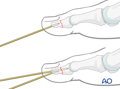 K-wire fixation for Distal hallux fractures