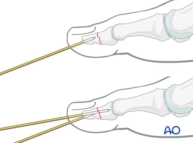 K-wire fixation for Distal hallux fractures