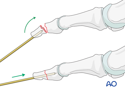 K-wire fixation for Distal hallux fractures