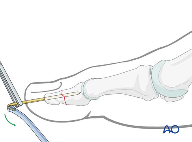 K-wire fixation for Distal hallux fractures