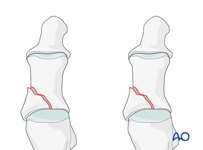 K-wire fixation for Partial articular fractures of the proximal hallux