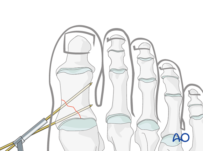 K-wire fixation for Partial articular fractures of the proximal hallux