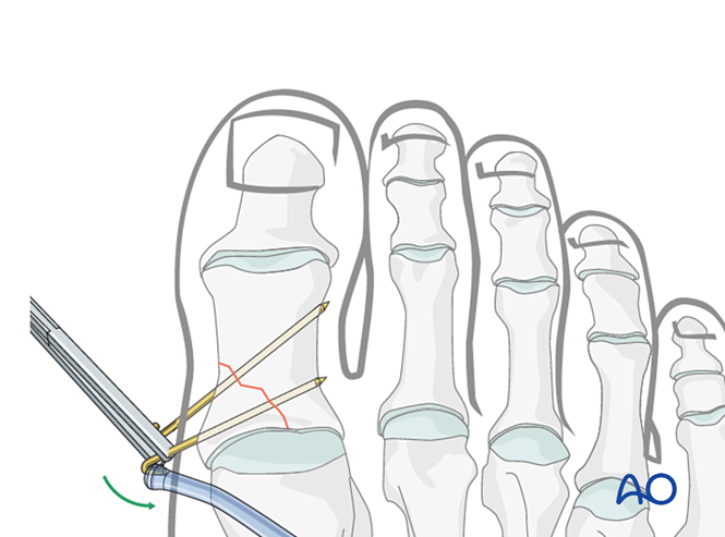 K Wire Fixation For Partial Articular Fractures Of The Proximal Hallux