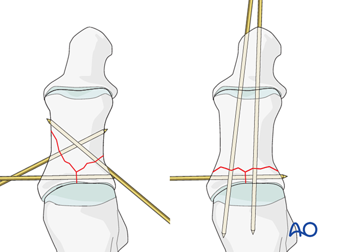 ORIF - K-wires for Complete articular fractures of the proximal hallux