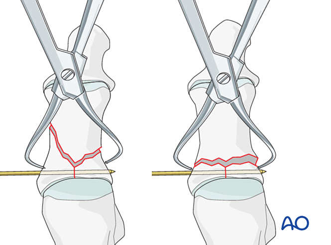 ORIF - K-wires for Complete articular fractures of the proximal hallux