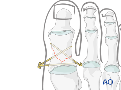 ORIF - K-wires for Complete articular fractures of the proximal hallux